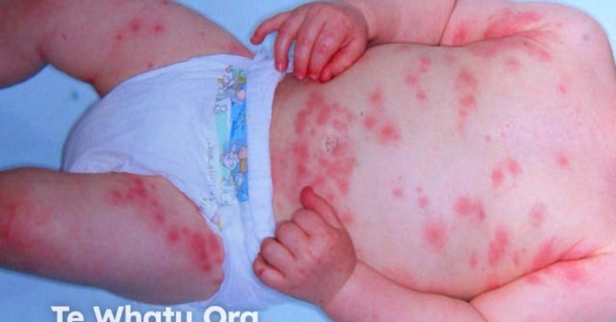 Urticaria in a child image