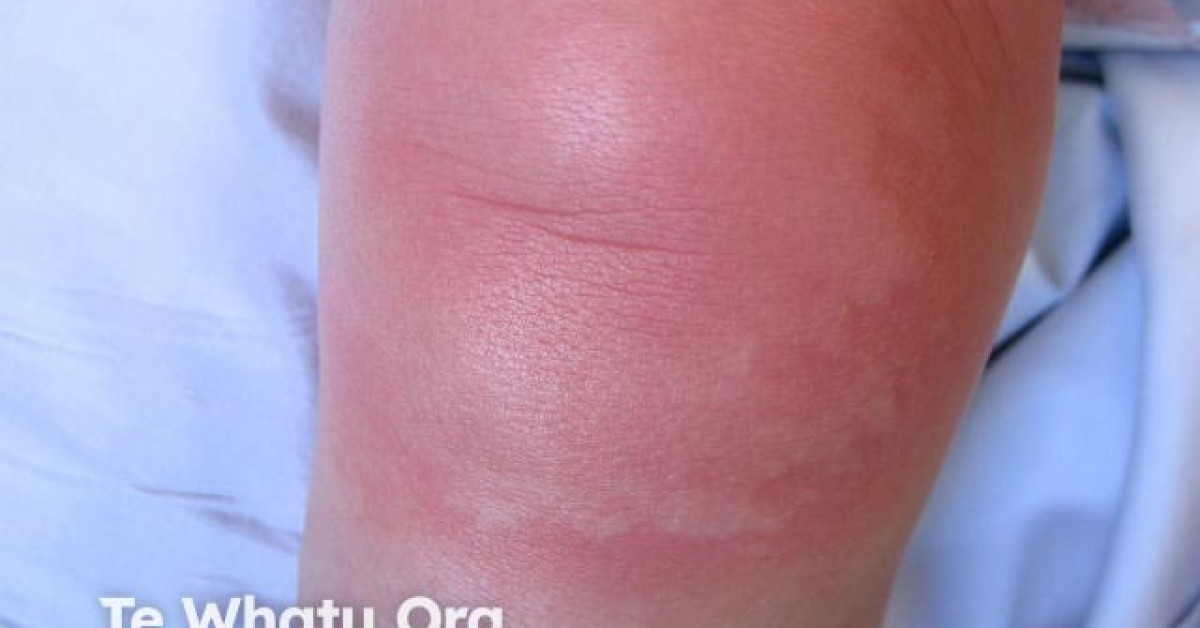 Urticaria in a child image