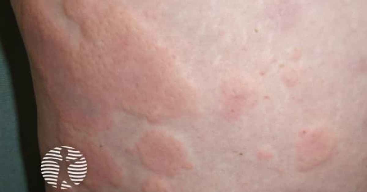 Urticaria image