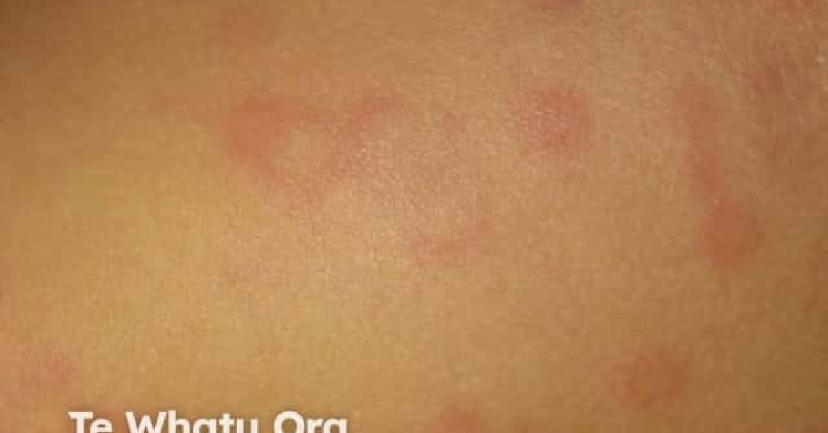 Spontaneous urticaria image