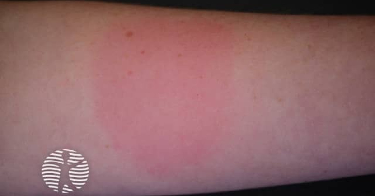 Dermographic urticaria image