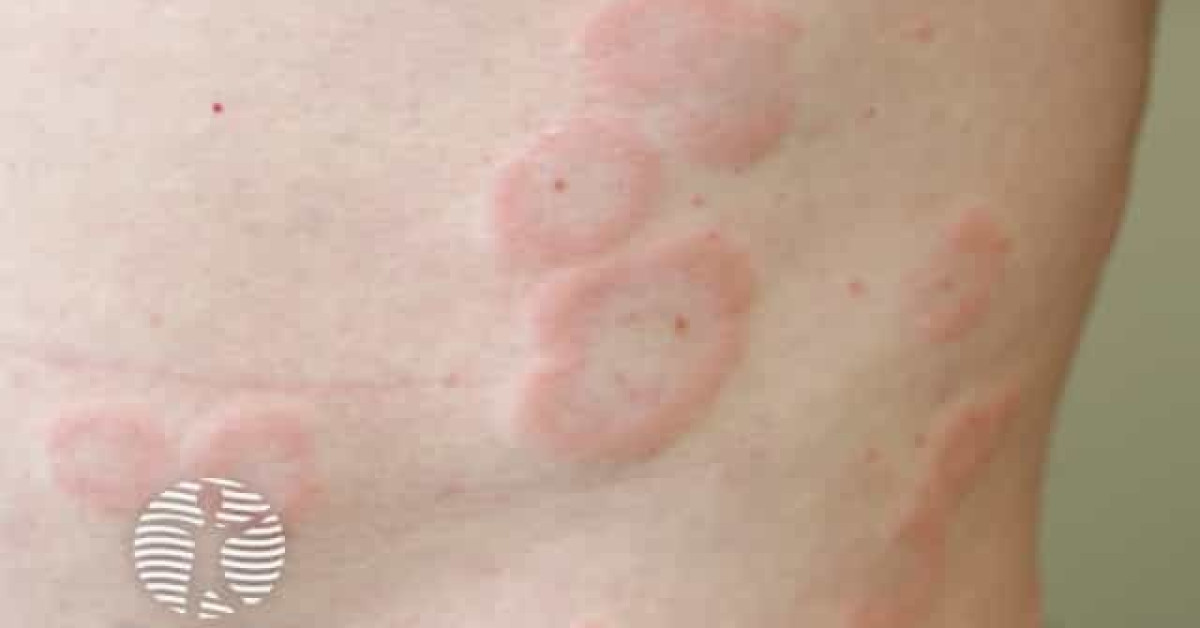 Spontaneous urticaria image