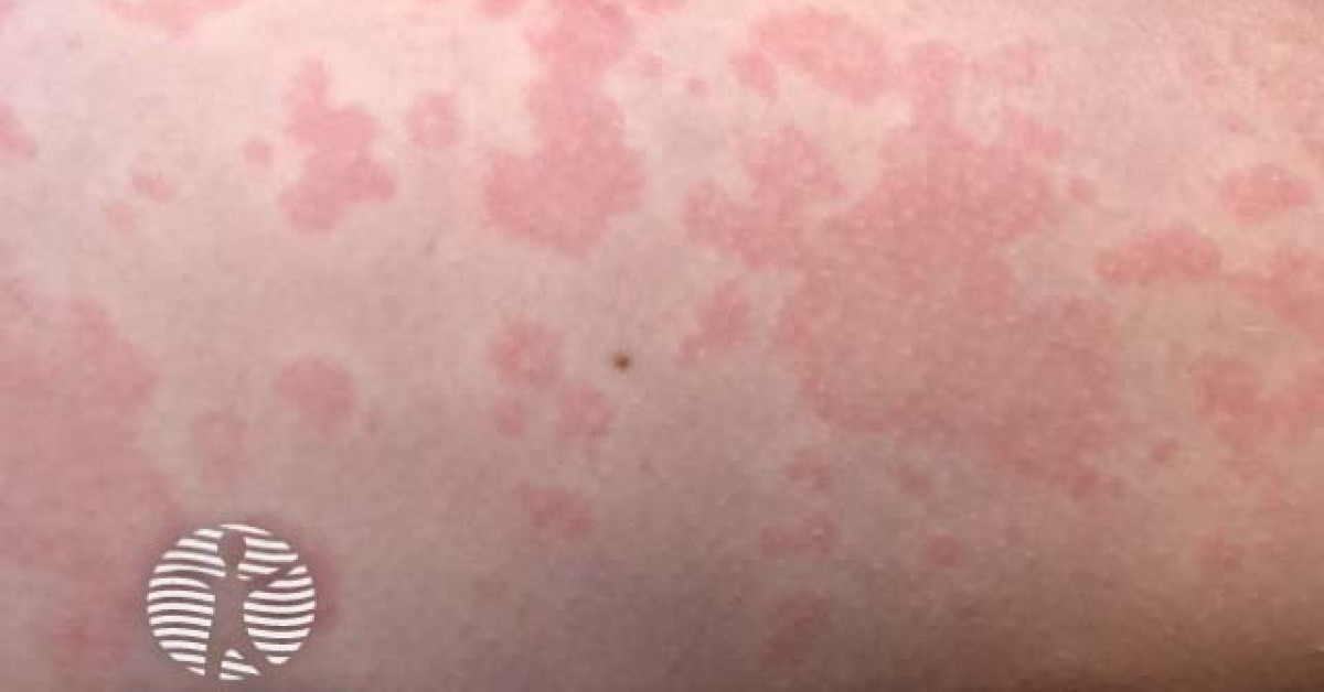 Urticaria image