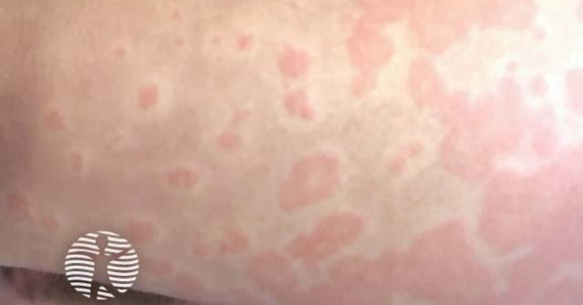 Urticaria image