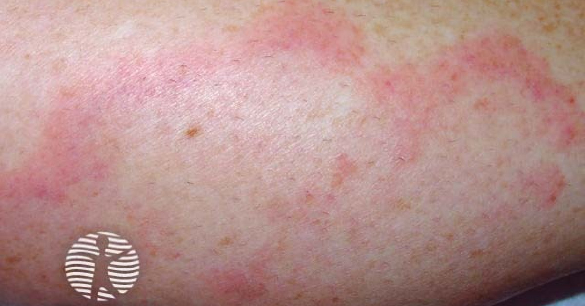 Urticarial vasculitis image