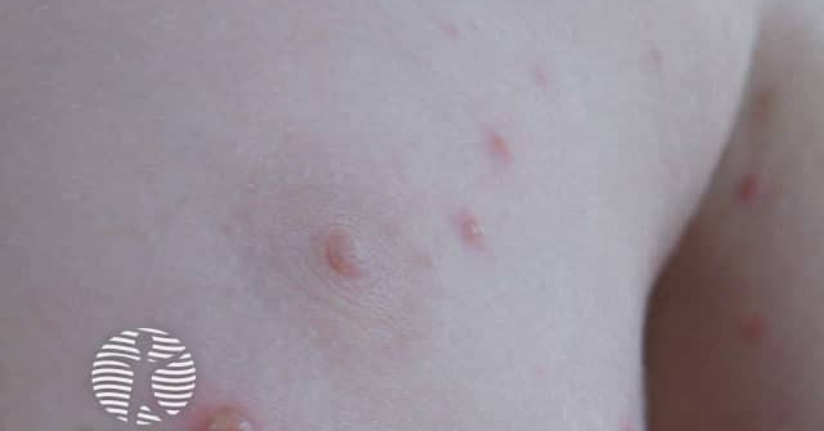 Varicella image
