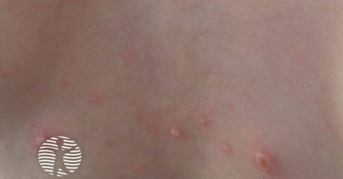 Varicella image