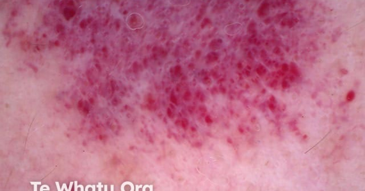 Vascular malformation, polarised dermoscopy view image