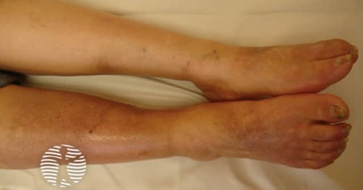 Lipodermatosclerosis image