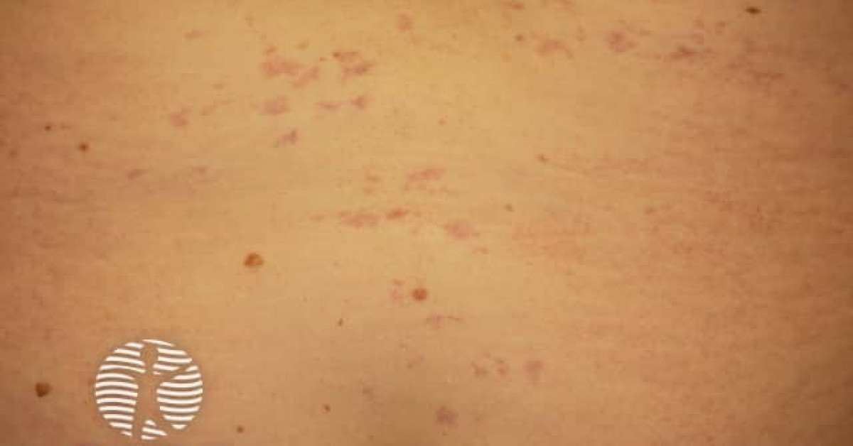 Benign hereditary telangiectasia image