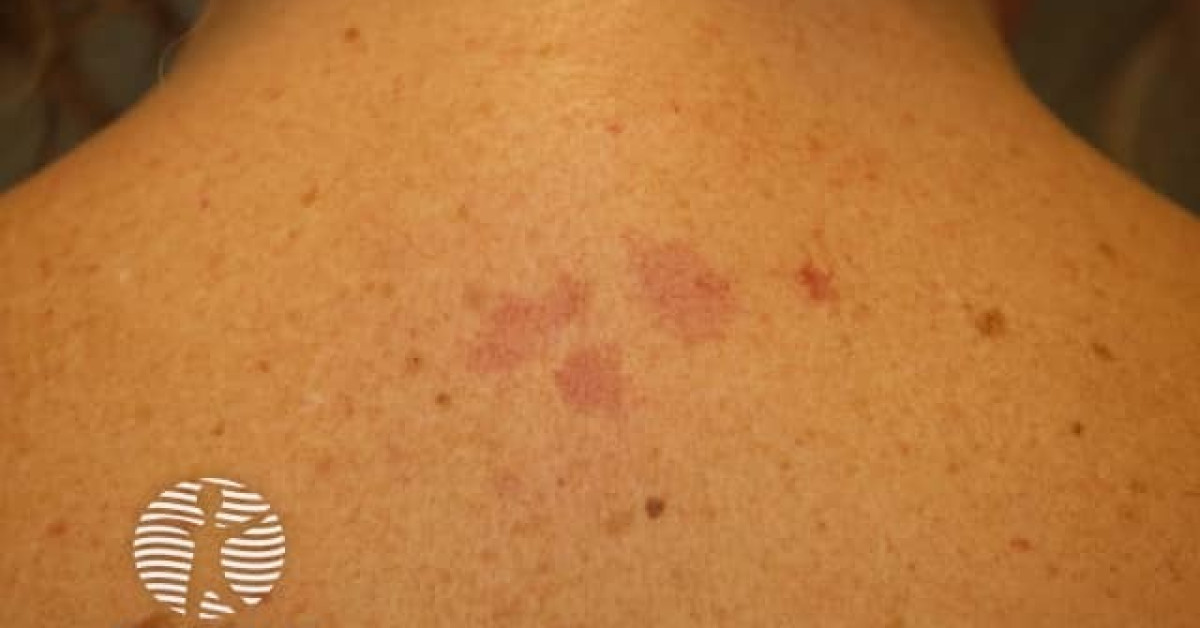 Benign hereditary telangiectasia image