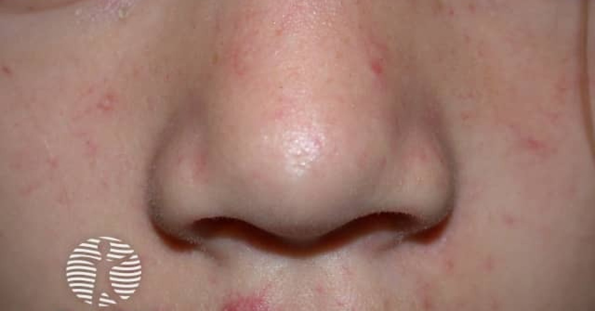 Benign hereditary telangiectasia image