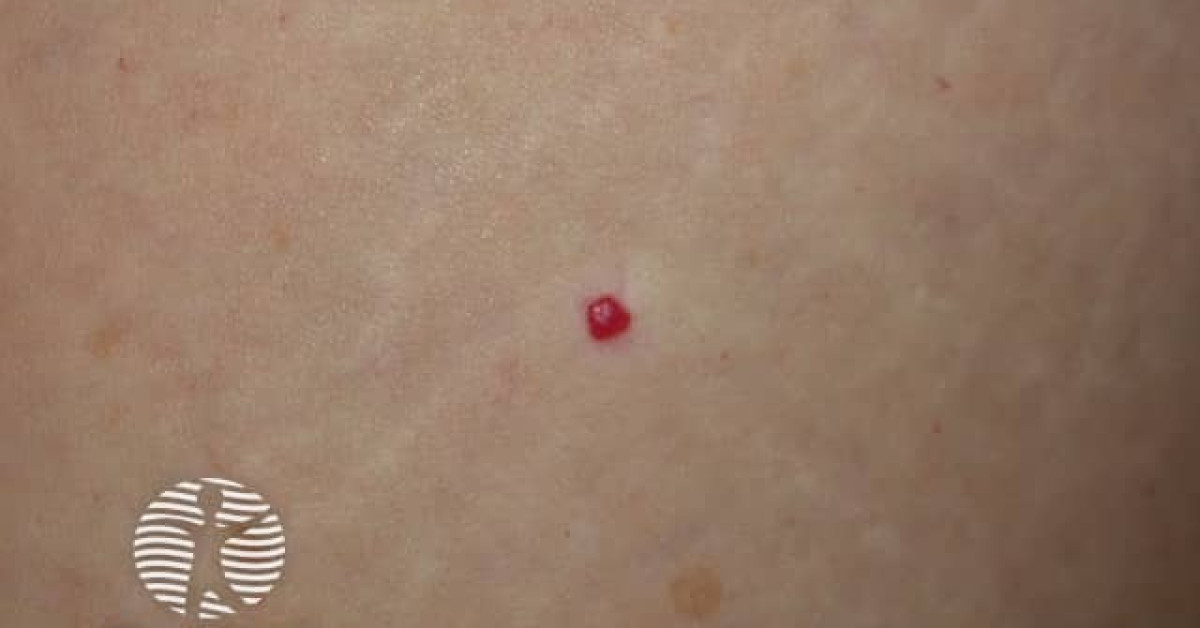 Cherry angioma image