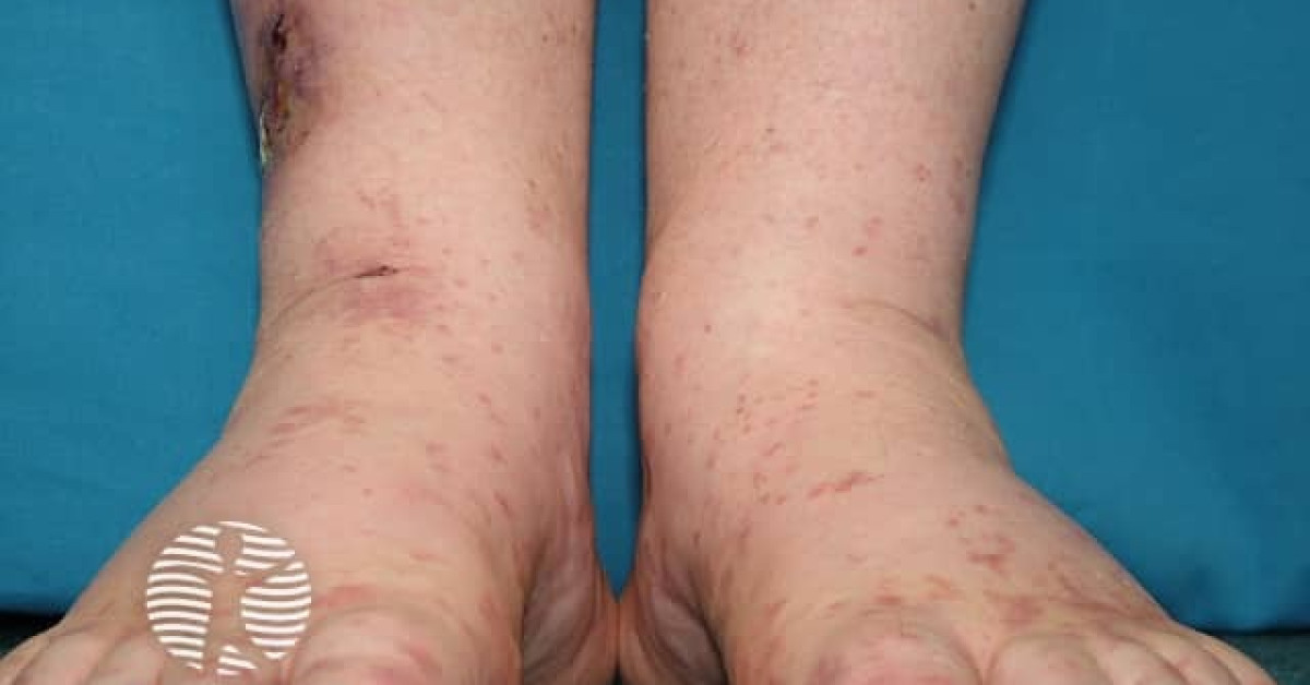 Cryoglobulinaemia image