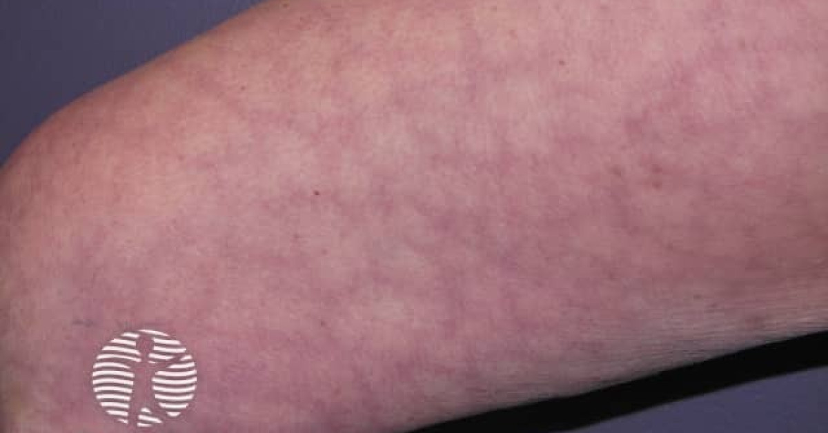 Cutis marmorata image