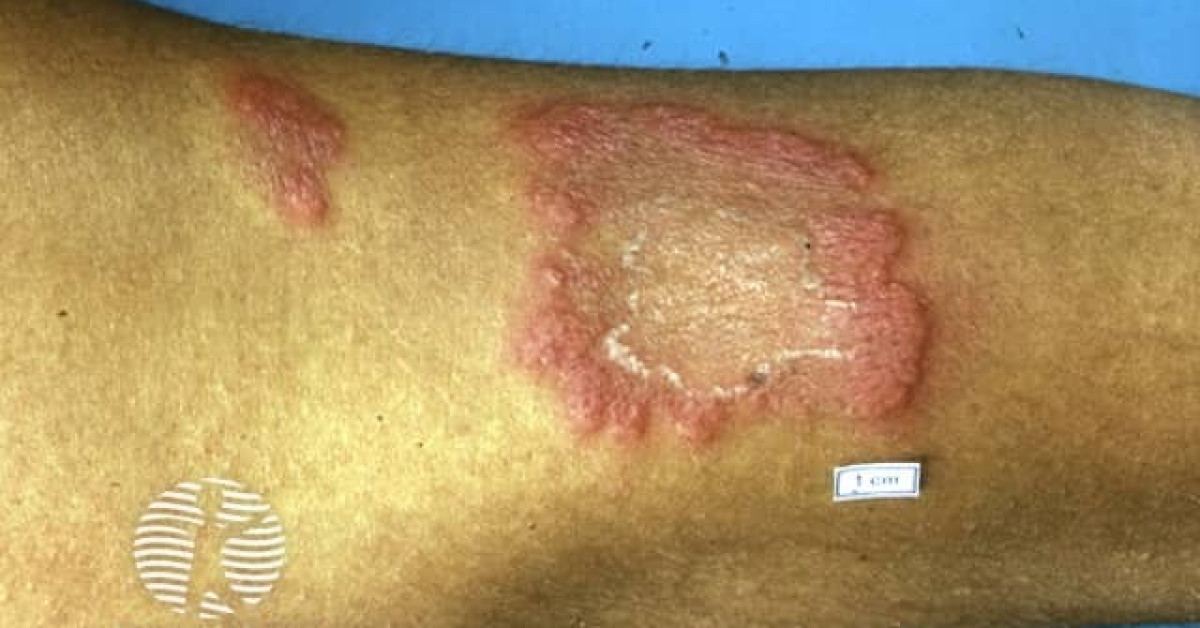 Erythema elevatum diutinum image