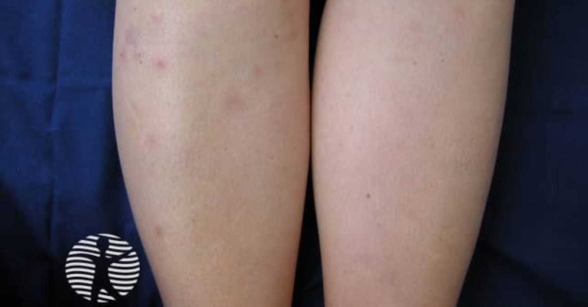 Erythema nodosum image