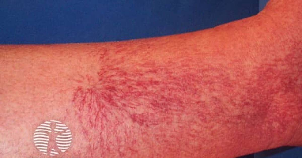 Essential telangiectasia image