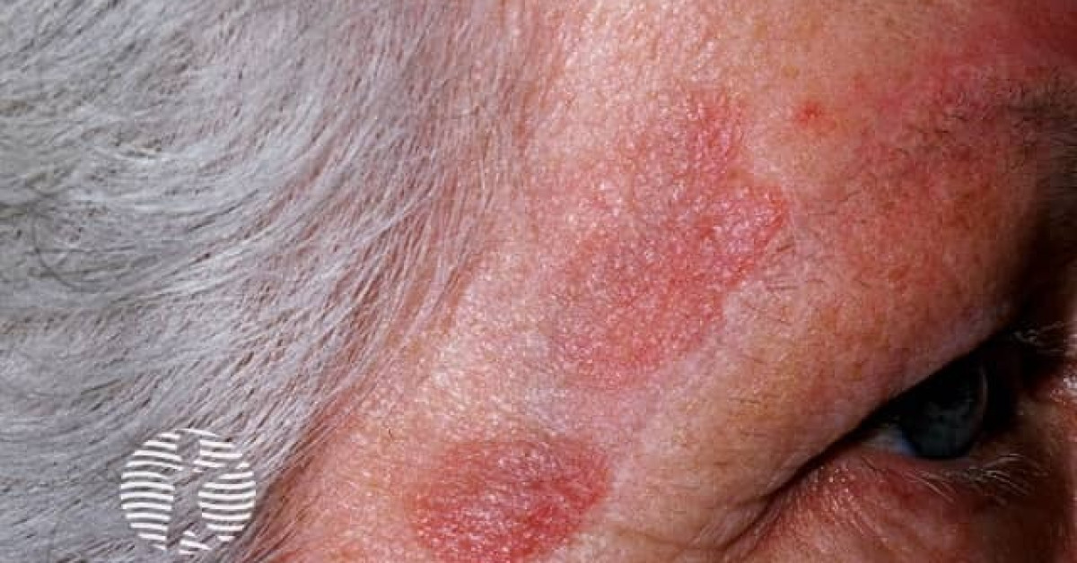 Granuloma faciale image