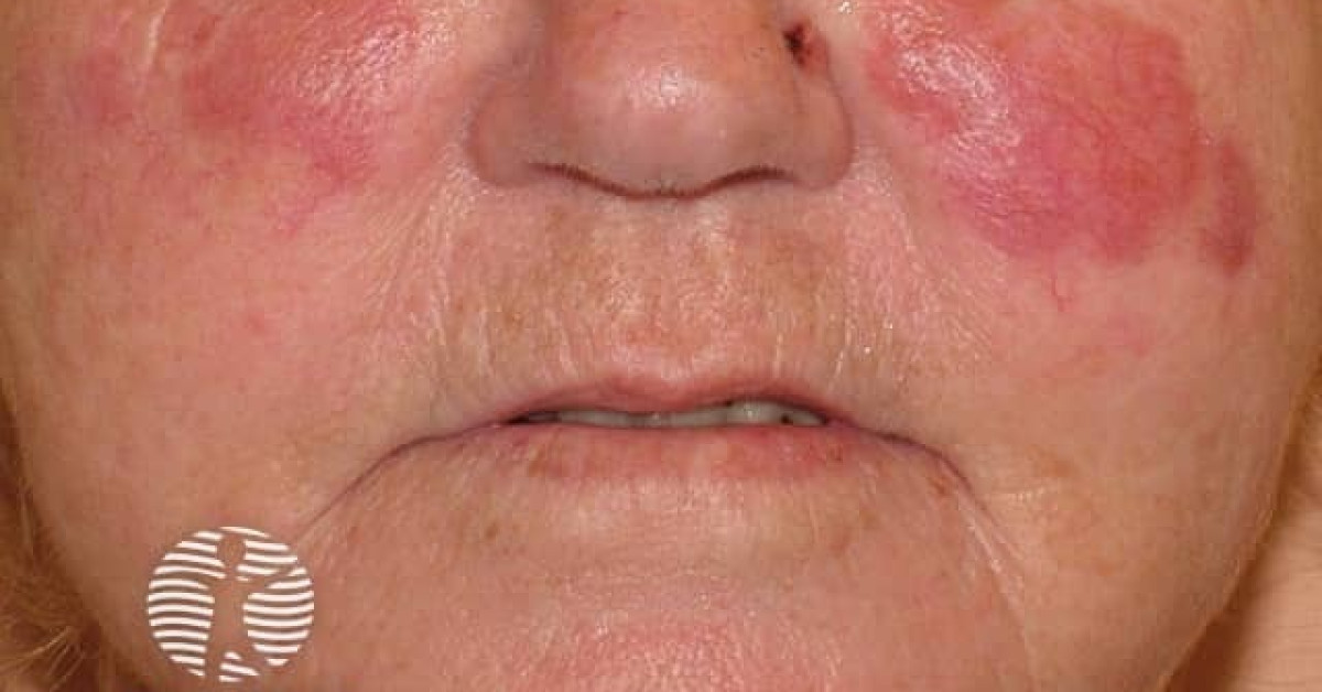 Granuloma faciale image
