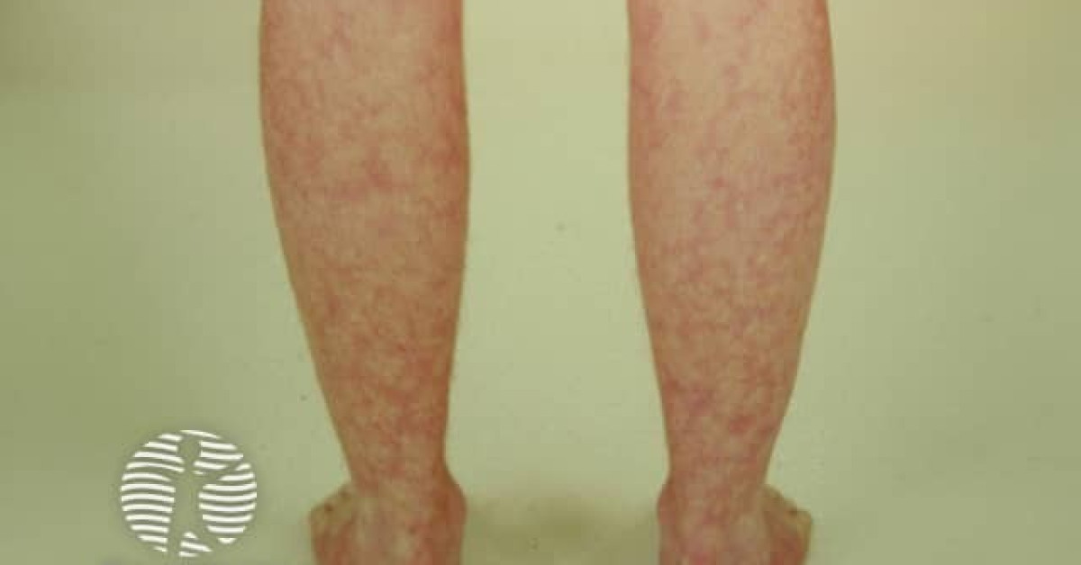 Livedo reticularis image