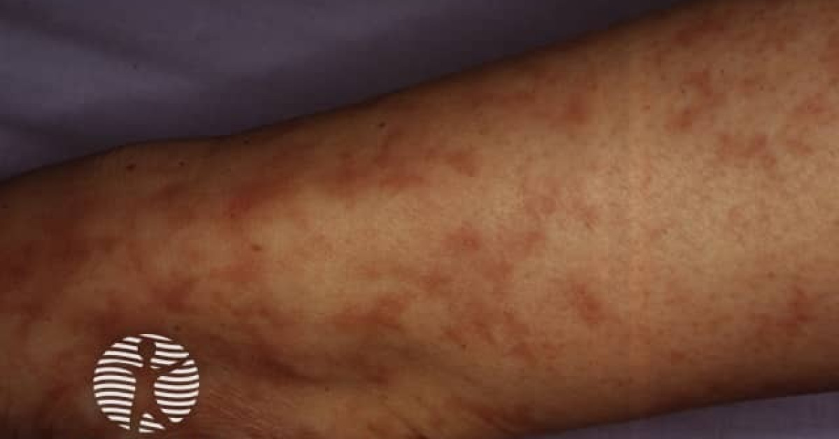 Livedo racemosa image