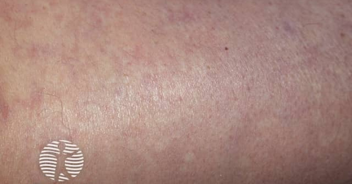 Naevus anaemicus image