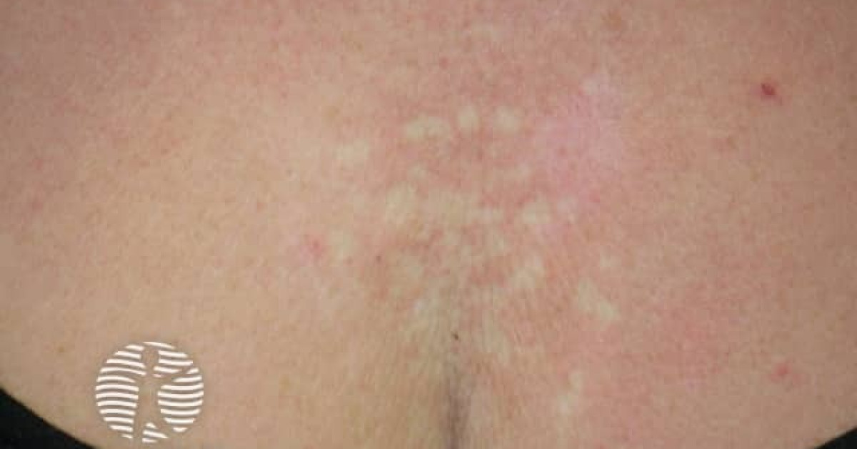 Naevus anaemicus image