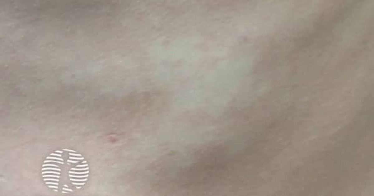 Naevus anaemicus image