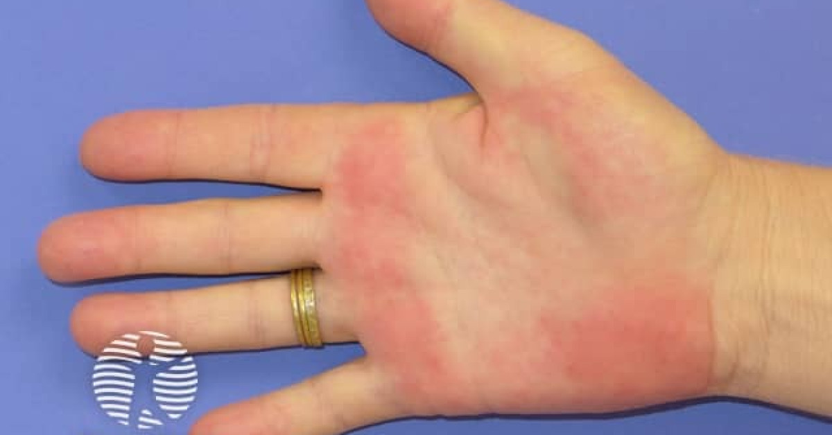 Palmar erythema image