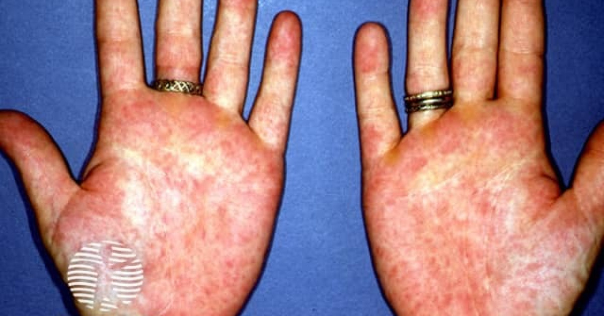 Palmar erythema image