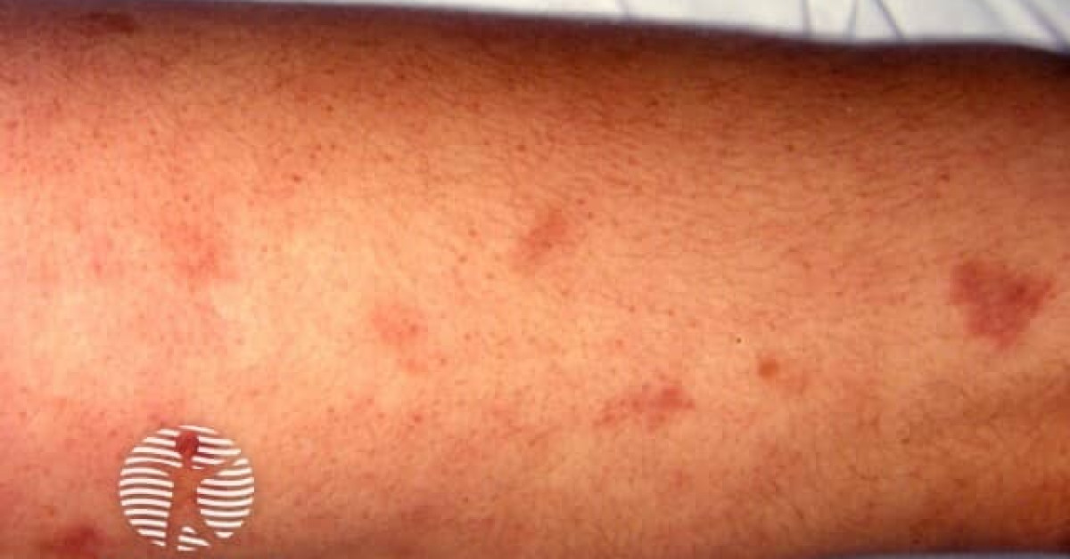 Cutaneous polyarteritis nodosa image