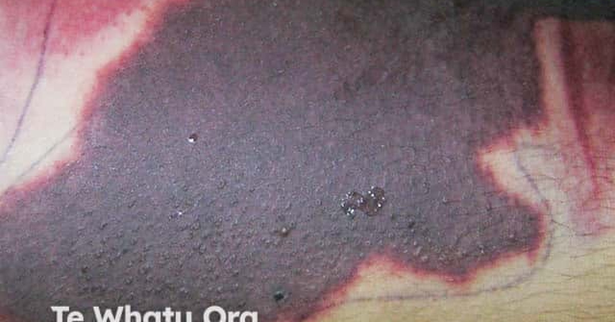 Disseminated intravascular coagulation image