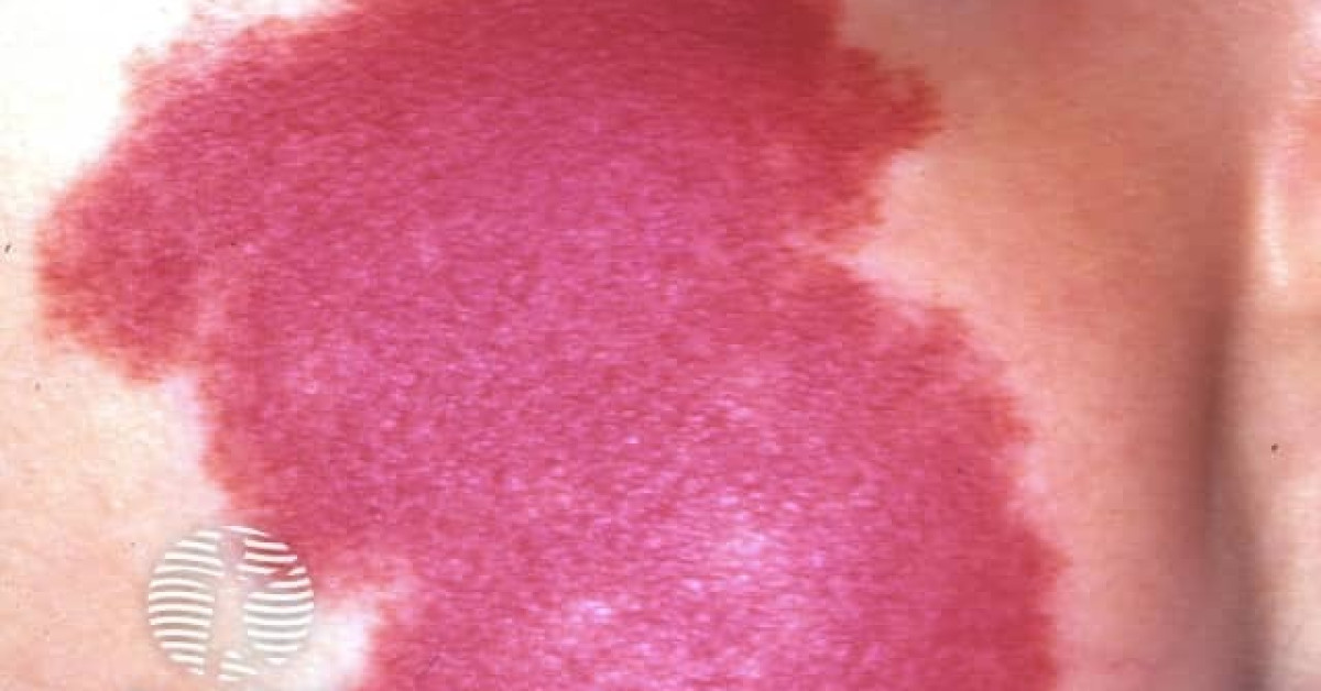 Port wine stain image