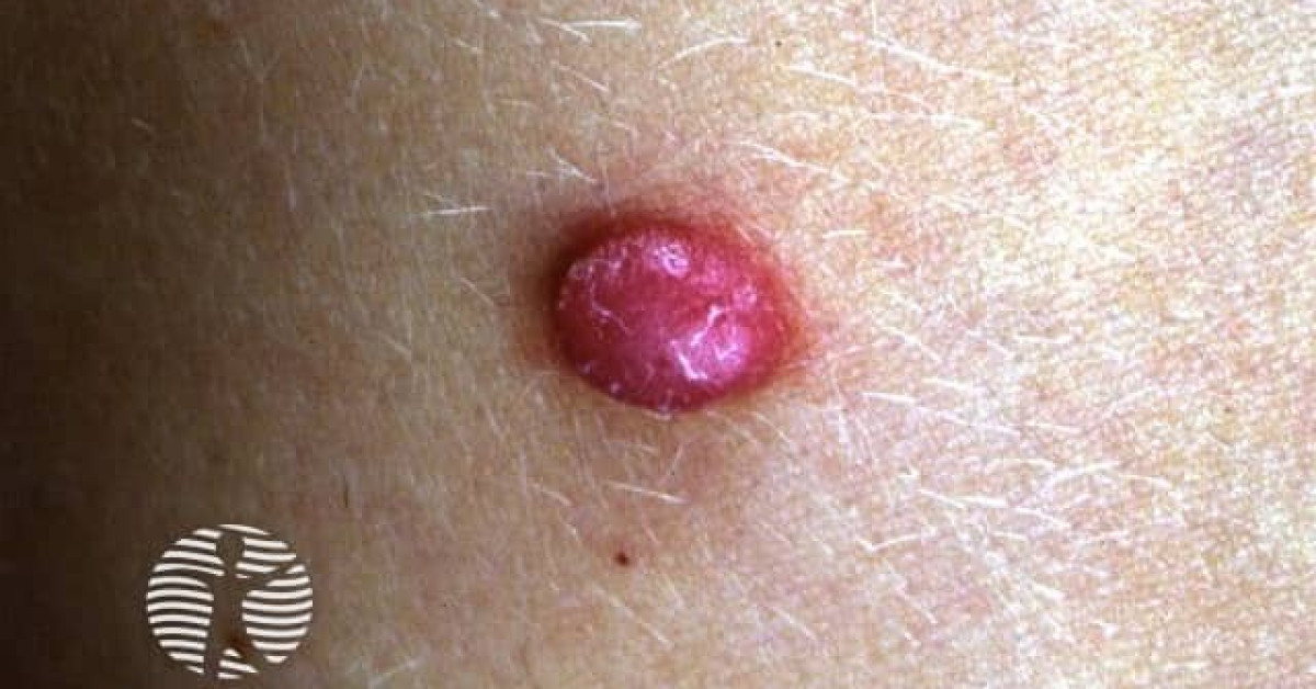 Pyogenic granuloma image