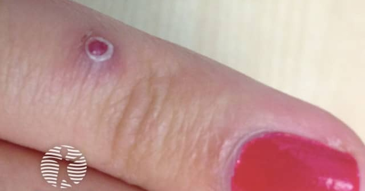 Pyogenic granuloma image