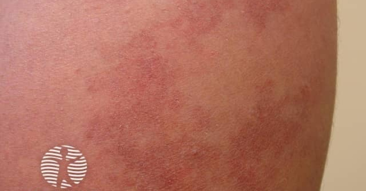 Reticular vascular naevus image