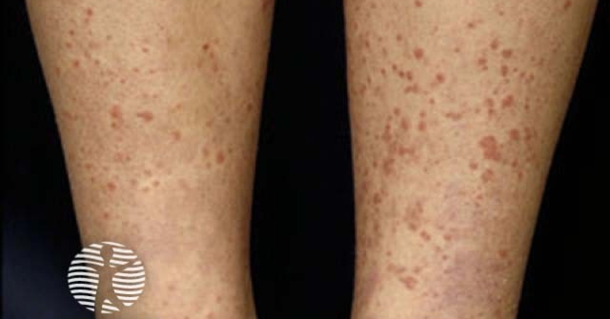 Henoch Schönlein purpura image