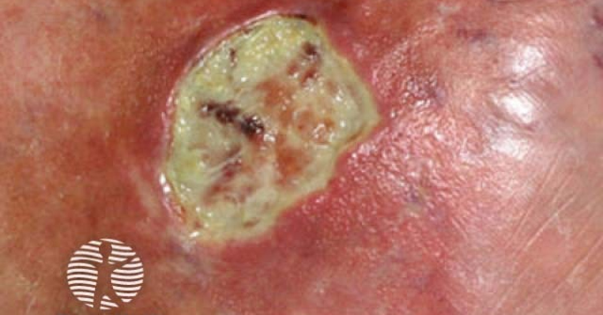Martorell ulcer image