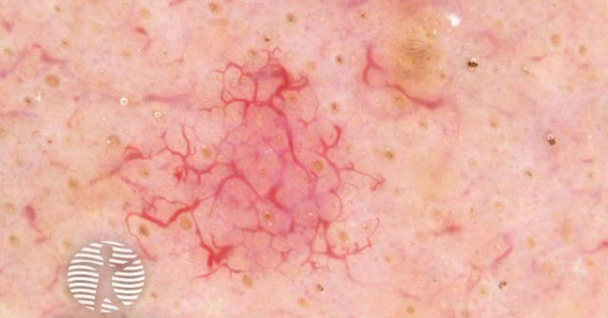 Telangiectasia image