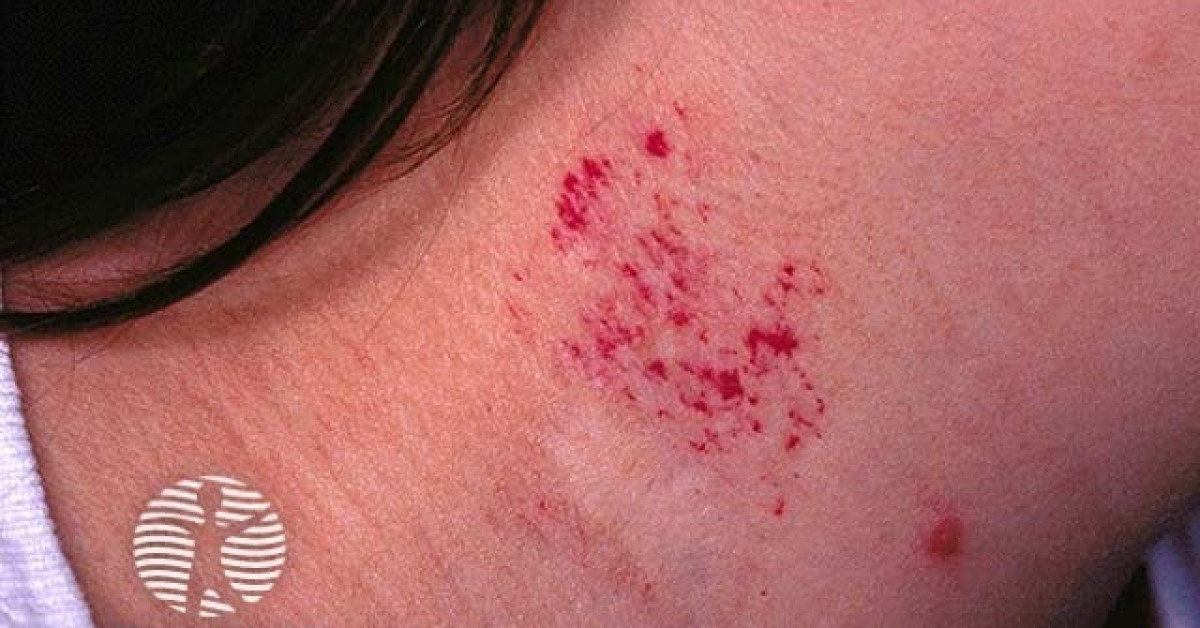 Vascular malformation image