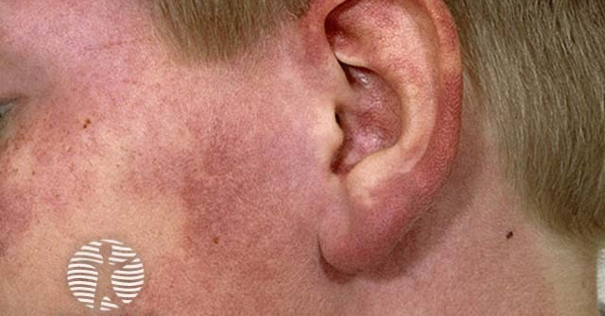 Vascular malformation image