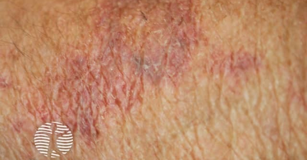 Senile purpura image