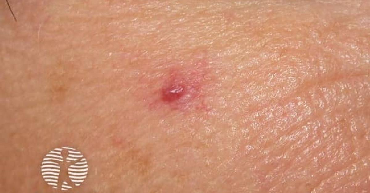 Spider telangiectasis image