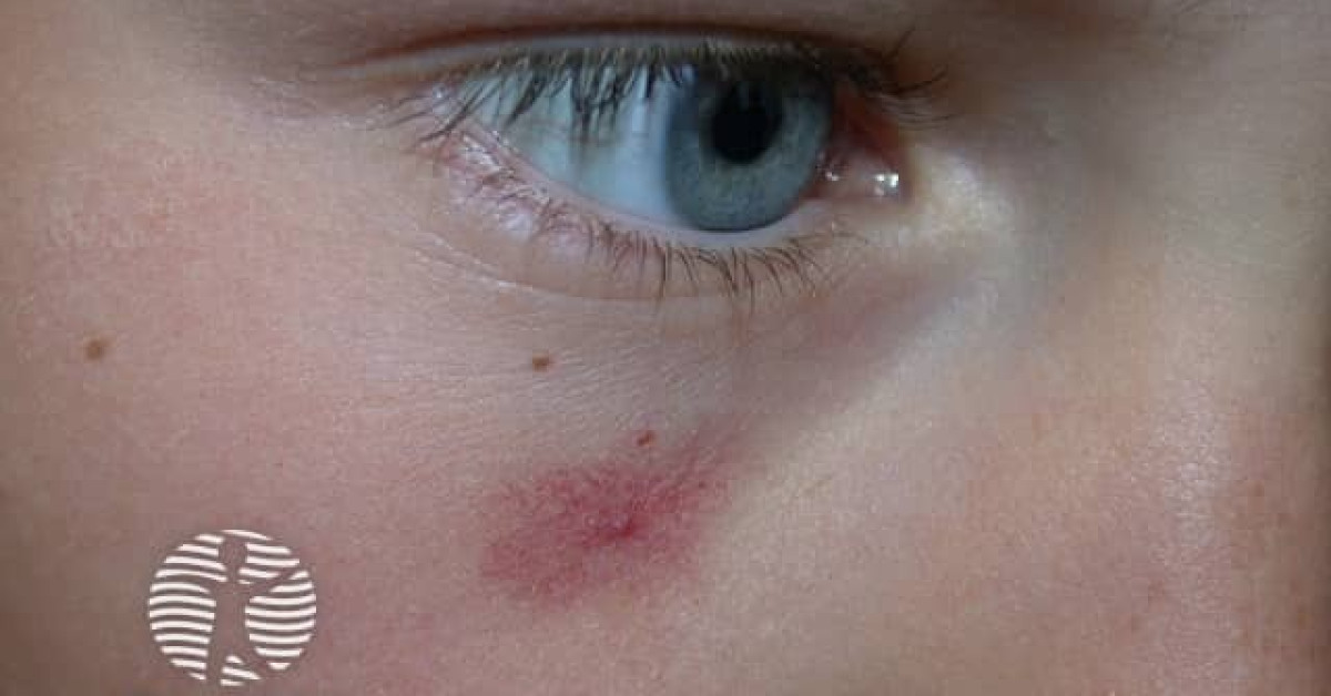 Spider telangiectasis image