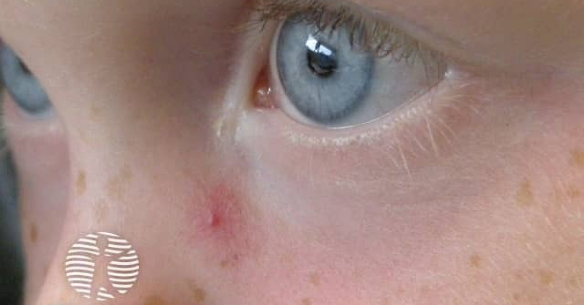 Spider telangiectasis image