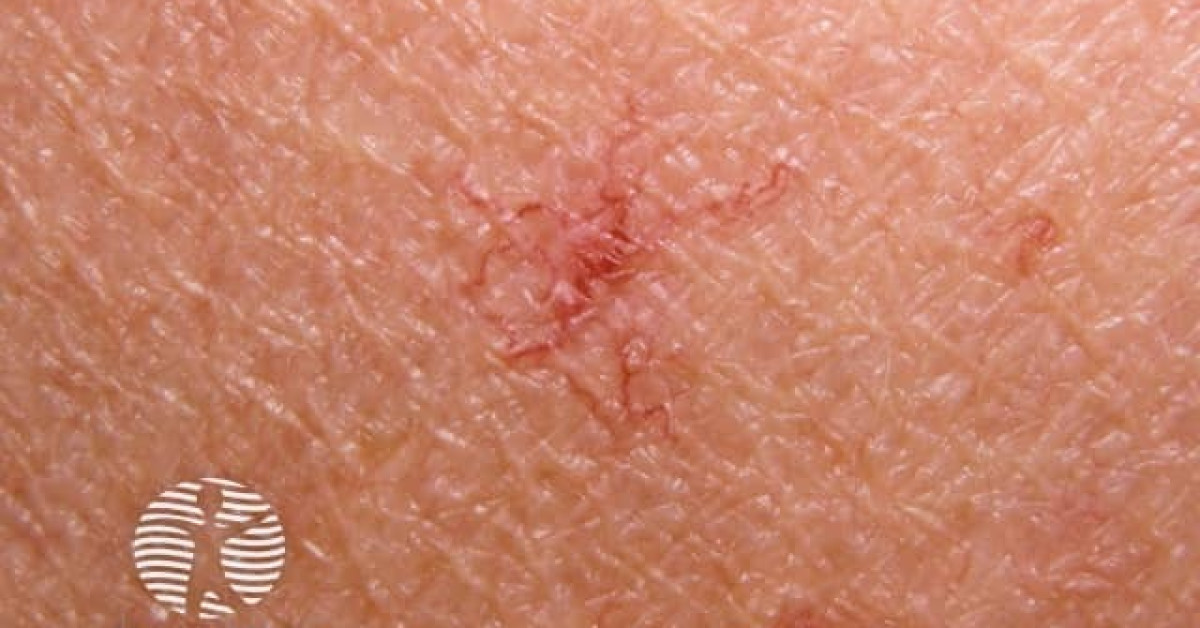 DermNet® - Spider naevus image