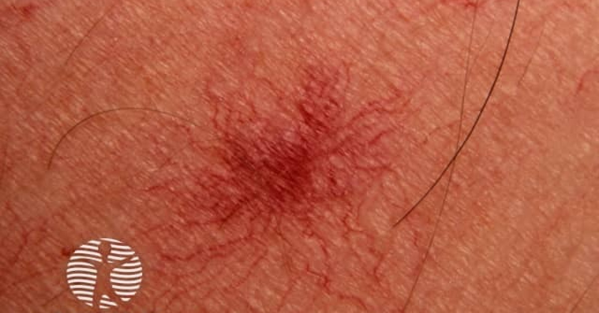 Spider naevus image