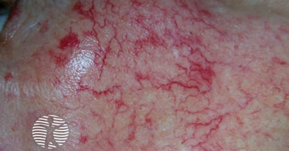 Familial telangiectasia image