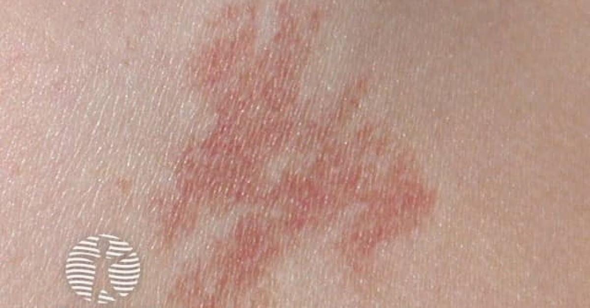 Benign hereditary telangiectasia image